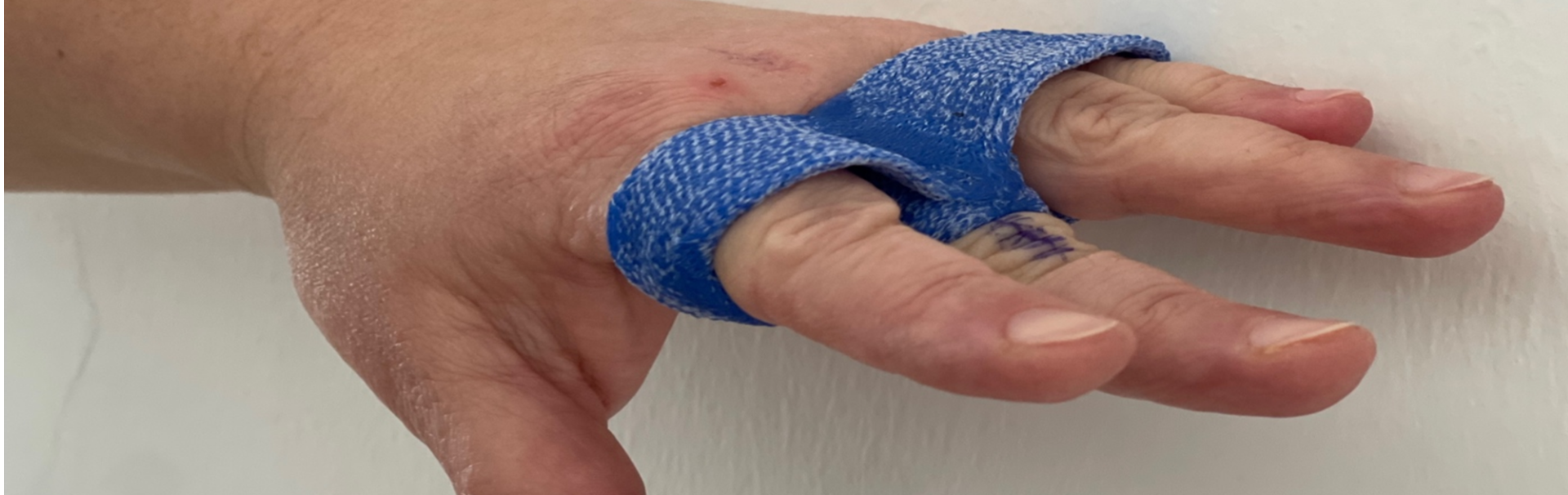 Strecksehnen-Verletzungen in Zone 3+4 - Nachbehandlung [2FP], Live-Zoom ...