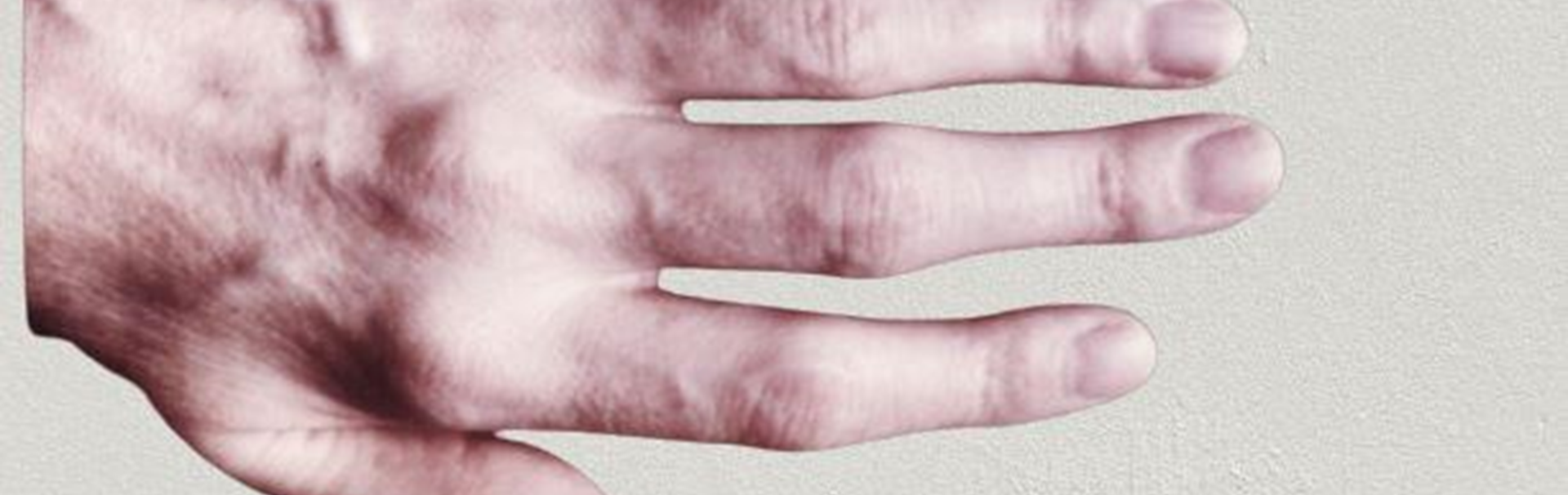 Rheuma–Behandlung der PIP und DIP [2FP], Live-Zoom-Webinar - Online ...