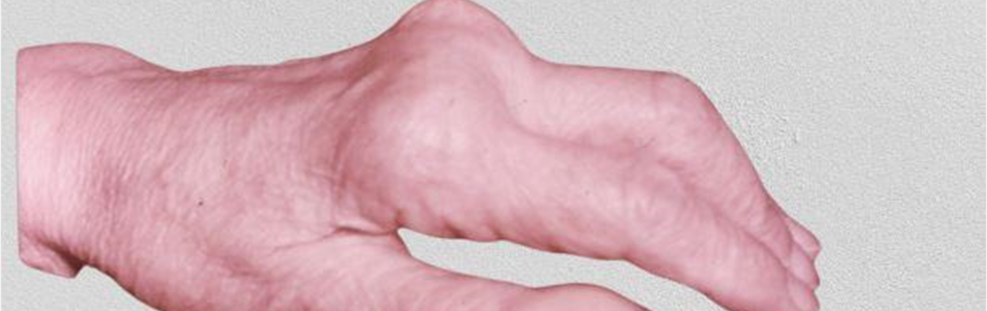 Rheuma-funktionelle Behandlung von Handgelenk und MCP [2FP], Live-Zoom ...